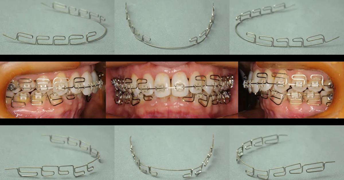 ついにMEAWワイヤーを装着しました！ | 銀座ルミナス歯科のブログ